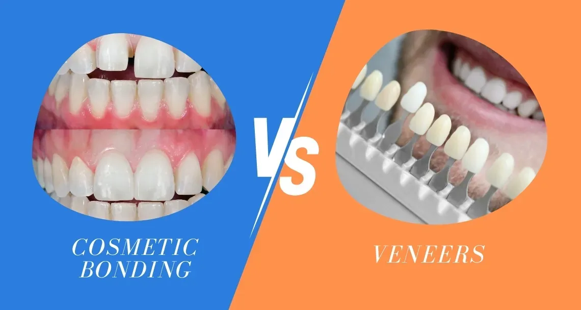 Veneers vs. Bonding: Which Smile Makeover Option Is Right